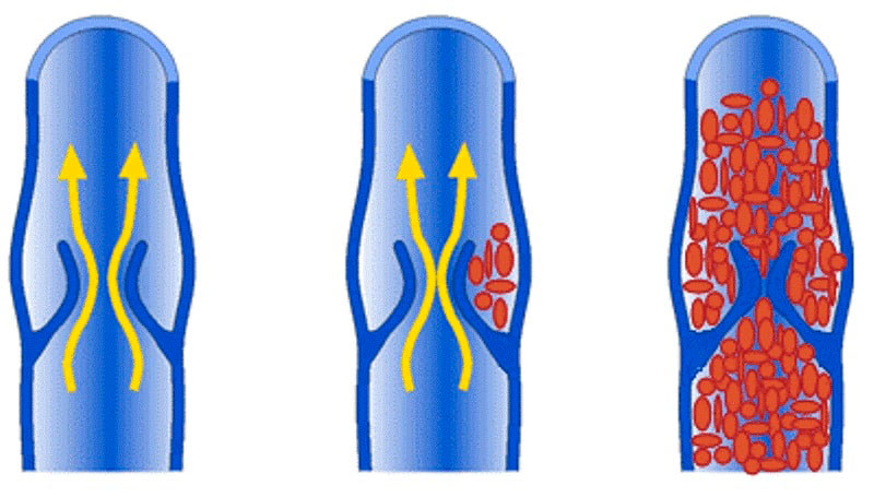 Thrombose - Diagnostik und Therapie im Venenzentrum Zürich